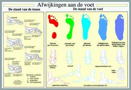 Poster afwijking v.d voet A2 geplast. - MSK Podiamed